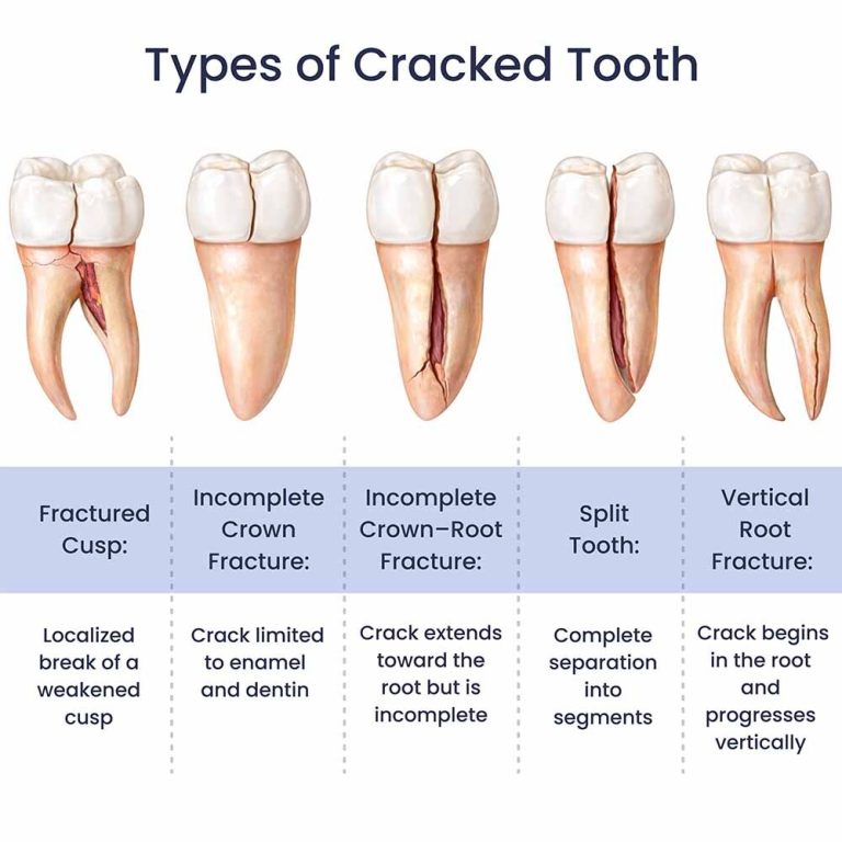 Cracked Teeth Treatment in Glendale | Chipped Tooth Repair in Queens, NY